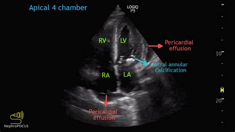 Identification Of Various Effusions On Standard Echocardiographic Views