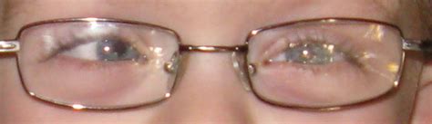 Xanders Eye Story Cyclic Esotropia Eye Patch Pattern Making