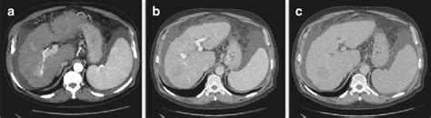 1 Typical Ct Imaging Features For Hepatocellular Carcinoma A Axial