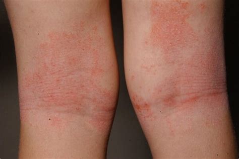 Understanding Atopic Dermatitis A Dermatologists Perspective Ruse