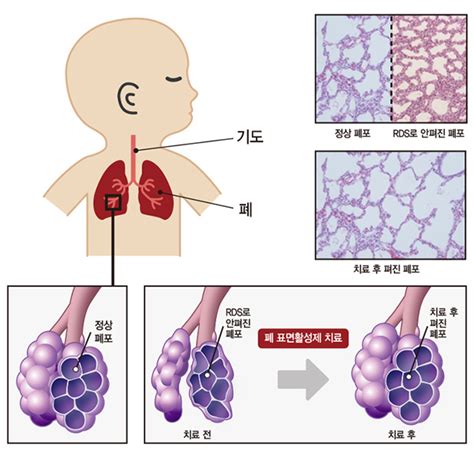 미숙아 사망률 1위 호흡곤란증후군 차세대 신약 개발 당신의 건강가이드 헬스조선
