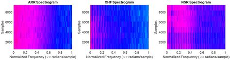 Deep Learning Based Arrhythmia Detection Using ECG Signals A Comparative Study And Performance