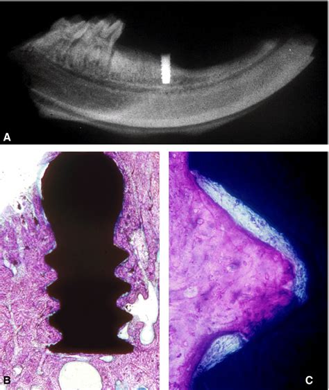 A Radiograph Of A Metallic Implant In The Post Tooth‐extraction Socket Download Scientific