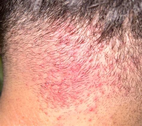 Dermatologist In Toronto R Folliculitis