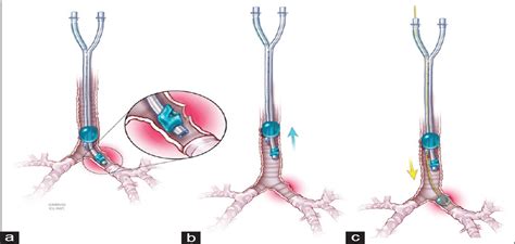 Bronchial Blocker And Double Lumen Endotracheal Tube Combina Annals Of Cardiac Anaesthesia