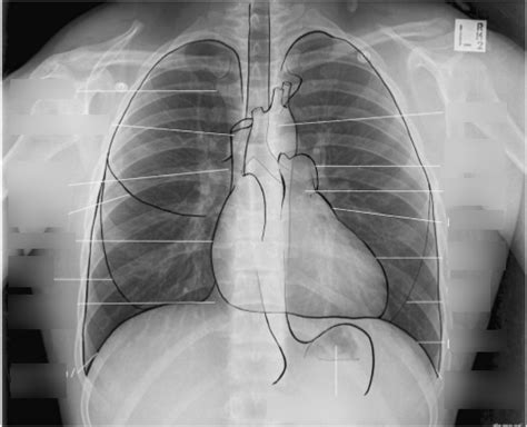 Chest X Ray Diagram Diagram Quizlet