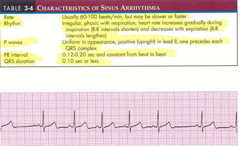 Characteristics Of Sinus Node Arrhythmias