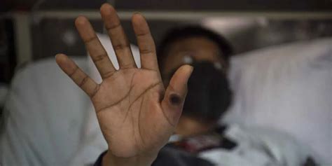 México 2024 Alerta Por El Aumento De Casos De Viruela Del Mono En El
