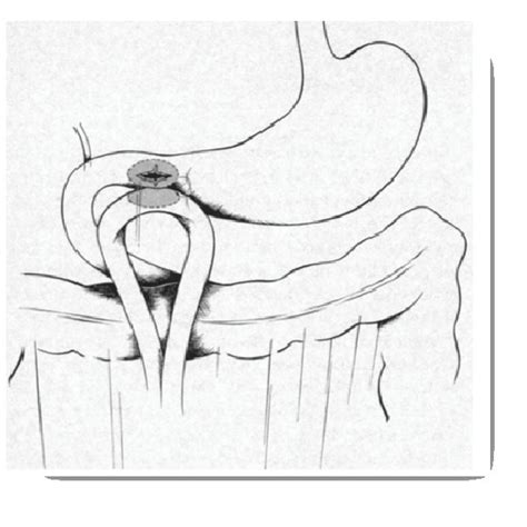 Pdf The Jejunal Serosal Patch Procedure A Successful Technique For