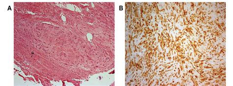 Figure 2 From Angioleiomyoma An Unusual Cause Of Thigh Pain Semantic