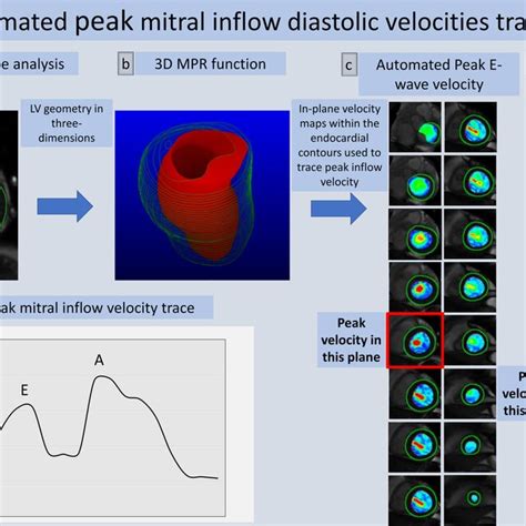 Peak Mitral Inflow Velocity Tracking On Mass Using 4d Flow Cmr The