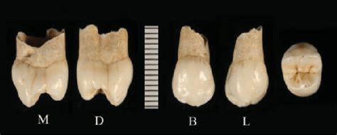 Mesial M Distal D Buccal B Lingual L And Occlusal Views Of