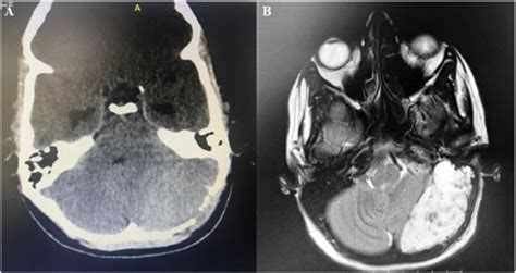 Preoperative Computed Tomography Showed An Iso To A Hyperdense Mass