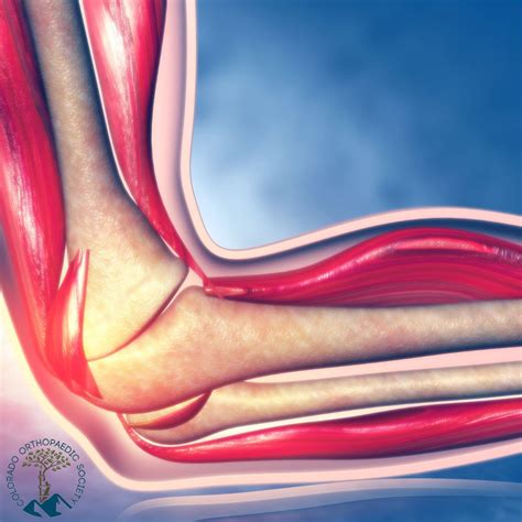 Colorado Orthopaedic Society On Linkedin Biceps Tendon Tear At The