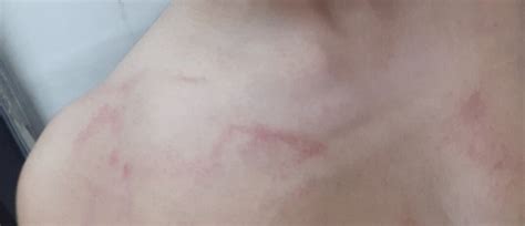 Shoulder Stretch Marks Looksmax Mens Self Improvement And Aesthetics