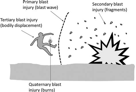 Blast Injuries A Guide For The Civilian Surgeon 57 Off