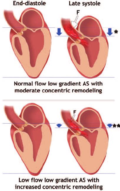 Significant Aortic Stenosis With Preserved Ejection Fraction And Low