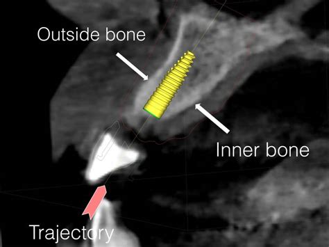 Surgical Guided Dental Implant Surgery Dr Sam Khoury