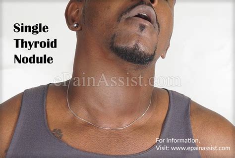 Diagnosis Of Small Or Large Solitary Or Single Thyroid Nodule