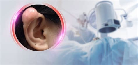 疤痕｜嶄新蟹足腫微創手術 如何透過細小傷口切除疤痕組織？
