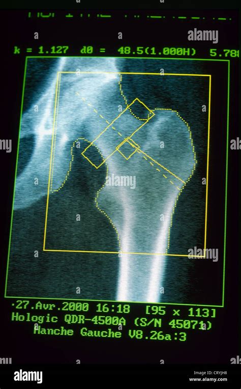Osteopenia Printable Information