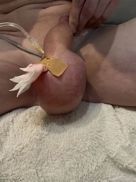 1 Liter Saline Injection 4 Nude Pics Xhamster