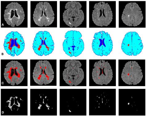 Brain Tissue Segmentation Examples Each Column Shows The Result Of The