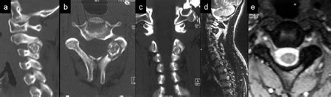 A 31 Year Old Female Patient Who Has Osteoid Osteoma In The Left Lamina