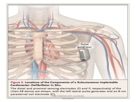Leadless Pacemaker And Subcutaneous Icd