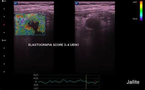 Plastron Apendicular