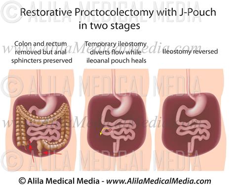 What Is A J Pouch Procedure At Liam Mckillop Blog