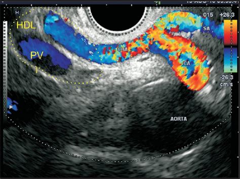 Endoscopic Ultrasound Of The Hepatoduodenal Ligament And Liver Hilum Pmc