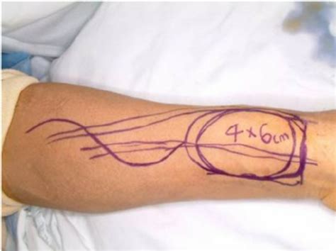 During Operation Patient No 3 Download Scientific Diagram