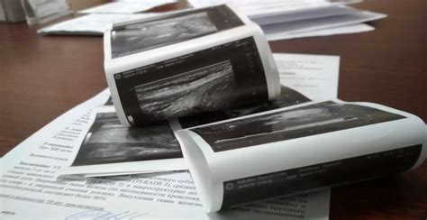 Как точно выявить Рак в узлах Щитовидной железы Новости науки Клиника щитовидной железы Дзен