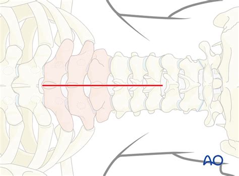 Posterior Access To The Cervicothoracic Junction C7 T2