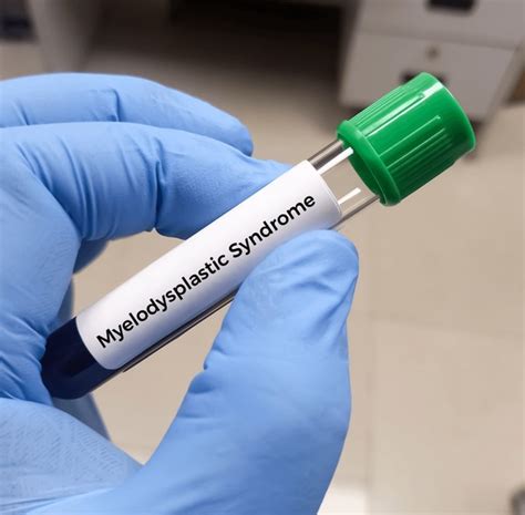 39 Bone Marrow Biopsy Myeloproliferative Neoplasms Royalty Free Images