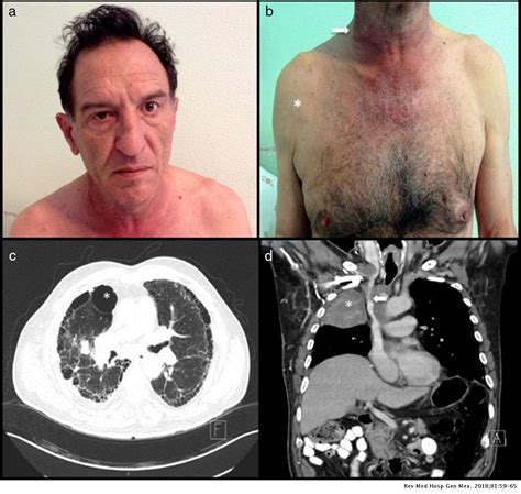 Superior Vena Cava Syndrome Anatomy