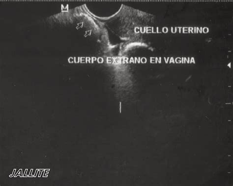 Cuerpo Extra O En Vagina