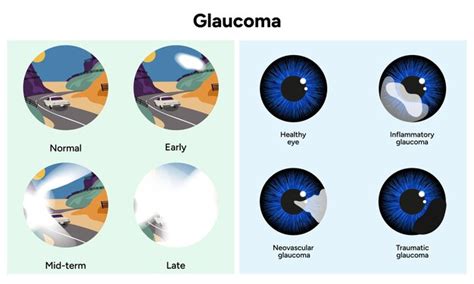 Glaucoma Vectors And Illustrations For Free Download Freepik