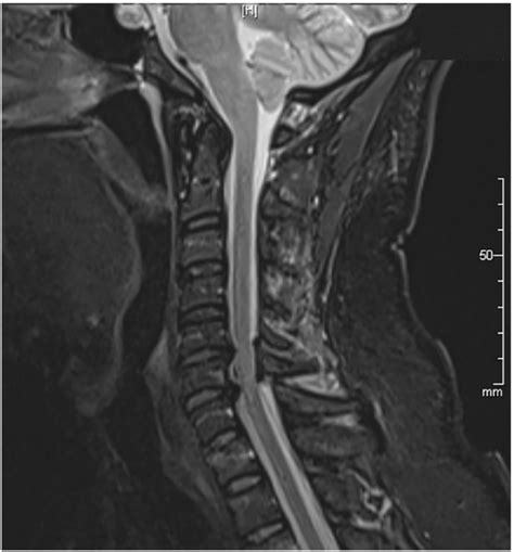 Fig C Sagittal T2 Stir Mri Of Cervical Spine Demonstrating Disrupted Download Scientific