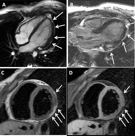 Image Of The Month August Multimodality Imaging In A Case Of Arrythmogenic Left