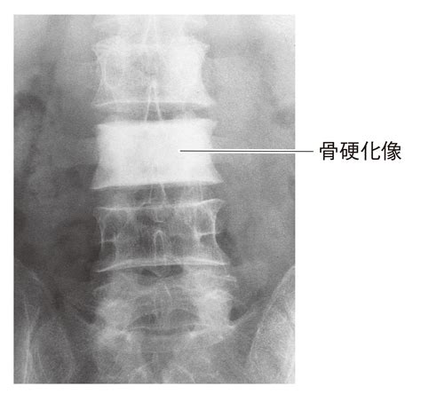 82c62 転移性骨腫瘍 国試 テコプラ