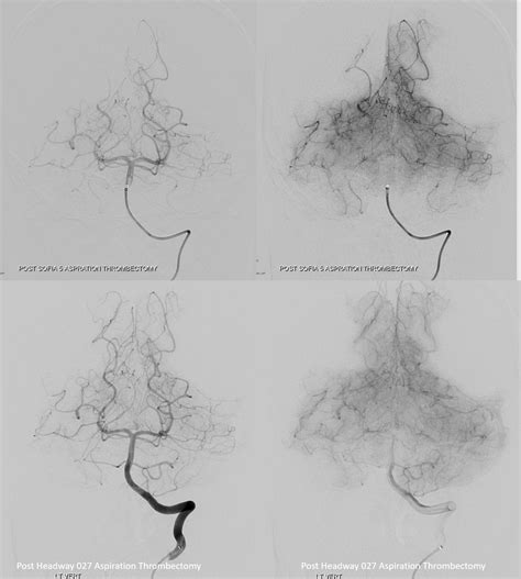 Pca Stroke Caution — Parallel Universe Pca Impostors — Circumflex And Choroidal