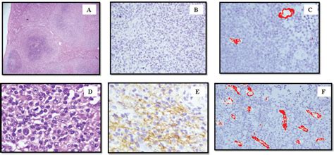 Photomicrograph Showing Neoplastic Follicles Of Low Grade Nhl Hande