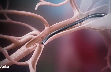 Jupiter Endovasculars Pulmonary Embolectomy Tech Wins Fda Ide