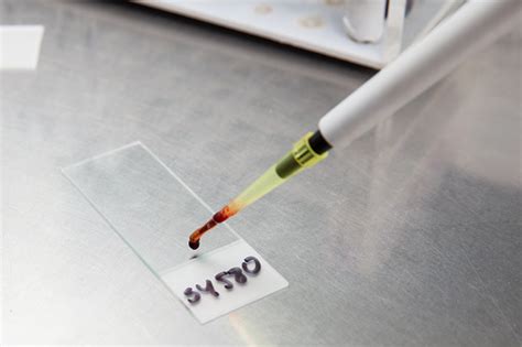 Bone Marrow Smear Preparationin The Laboratory Blood Smear