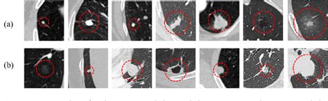 figure 1 from improved complementary pulmonary nodule segmentation