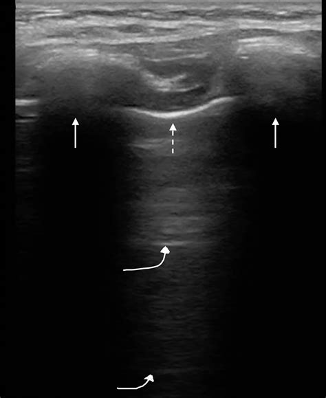Lung Ultrasound A Practical Review For Radiologists Applied Radiology
