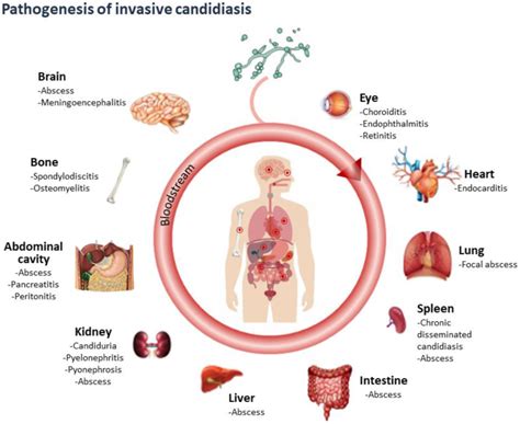 Candidiasis Definition Causative Agent Types Transmission