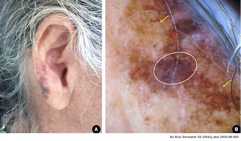 Ear Melanoma A Four Case Series Anais Brasileiros De Dermatologia